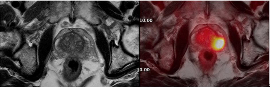 Latest Prostate Cancer Imaging Technique Transforms Our Ability to ...