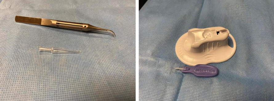 Improved Treatment Technique for Fuchs’ Dystrophy Shows Promise