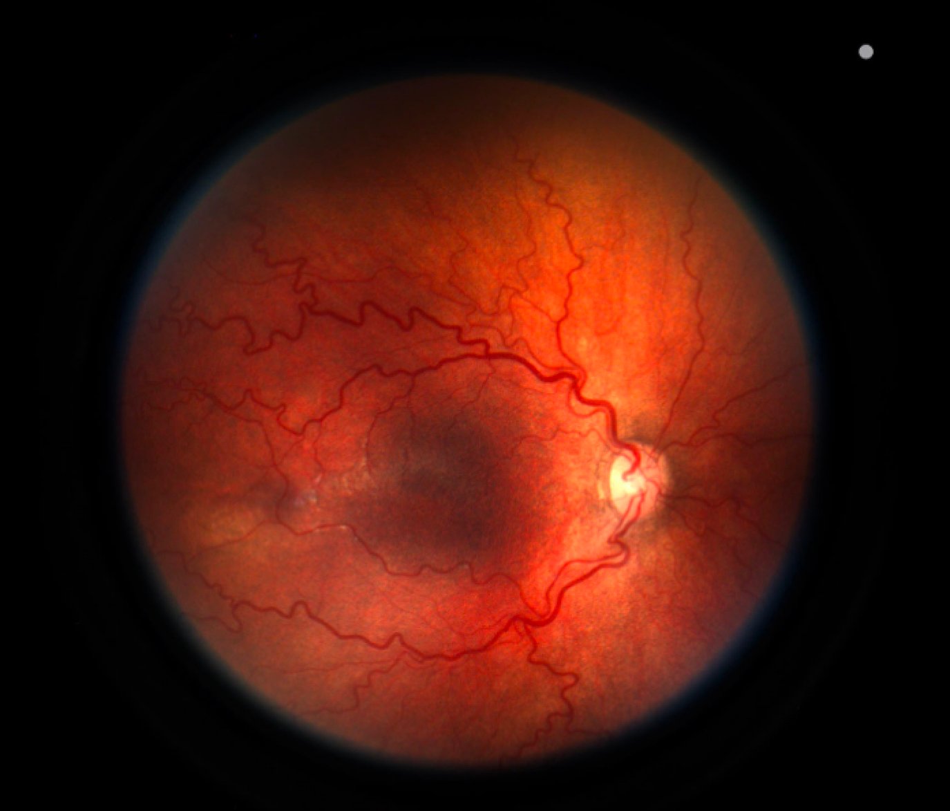 First Telemedicine Service Launched in Colorado for Infants with ...